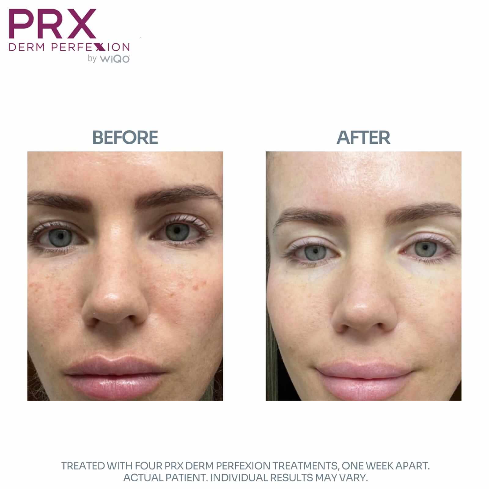 PRX Treatments in Tacoma