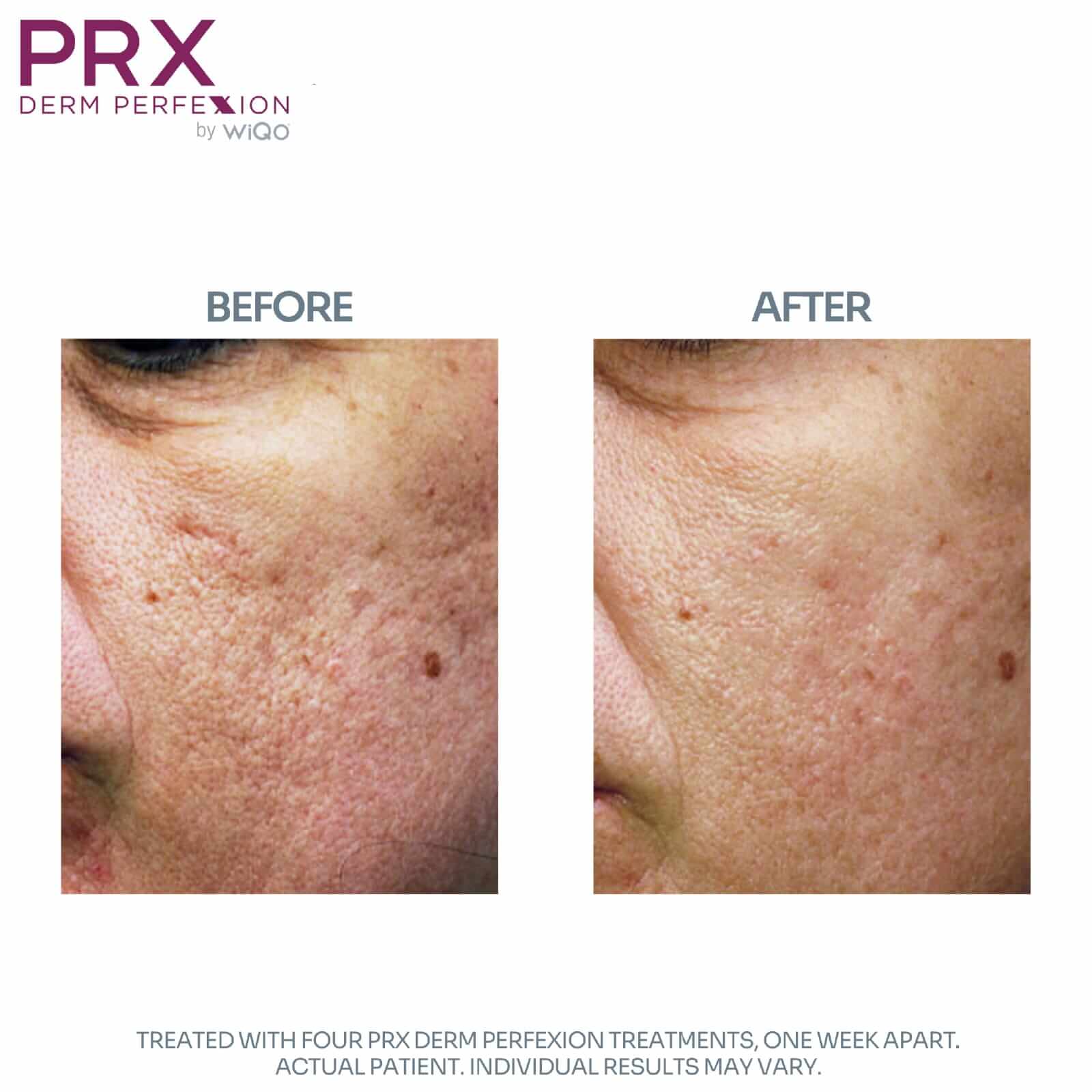 PRX Treatments in Tacoma