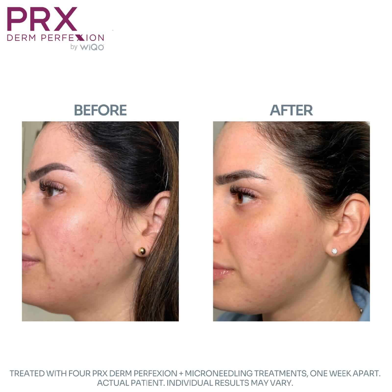 PRX Treatments in Tacoma